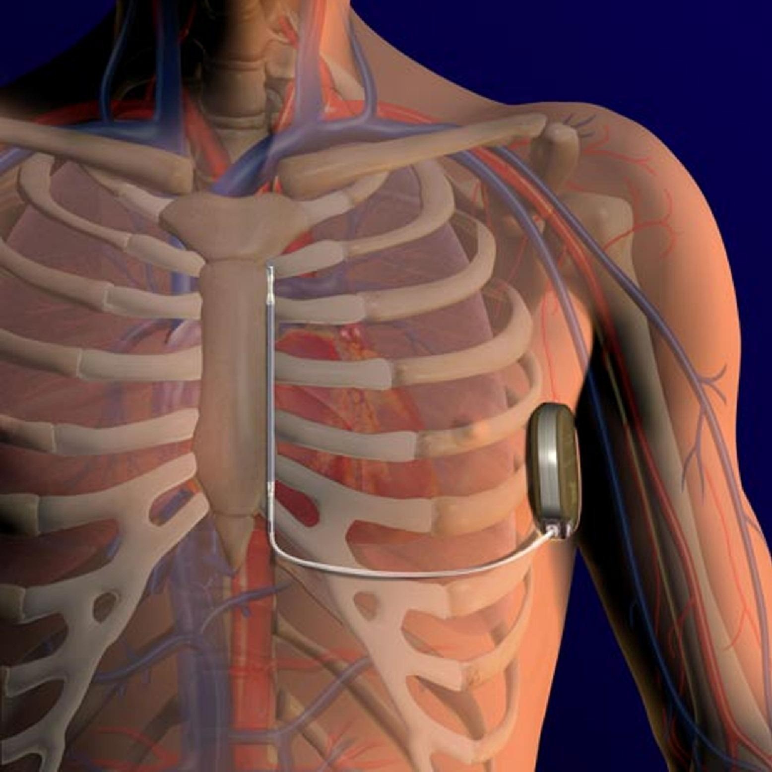 Subcutaneous Implantable Defibrillator - Rhythm & Cardiac Specialists Subcutaneous Implantable Defibrillator - Rhythm & Cardiac Specialists