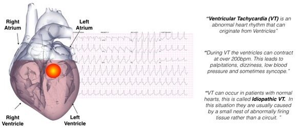 Ventricular Tachycardia (VT) Ablation in Normal Hearts - Rhythm ...